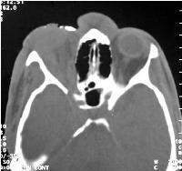 Cirurgia e Traumatologia BucoMaxiloFacial: MIÍASE CUTÂNEA HUMANA COM ...